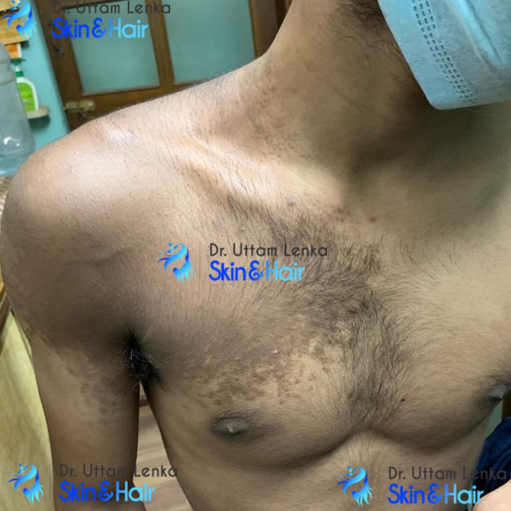Beckers Nevus Dr Uttam Lenkas Skin Hair And Laser Clinic