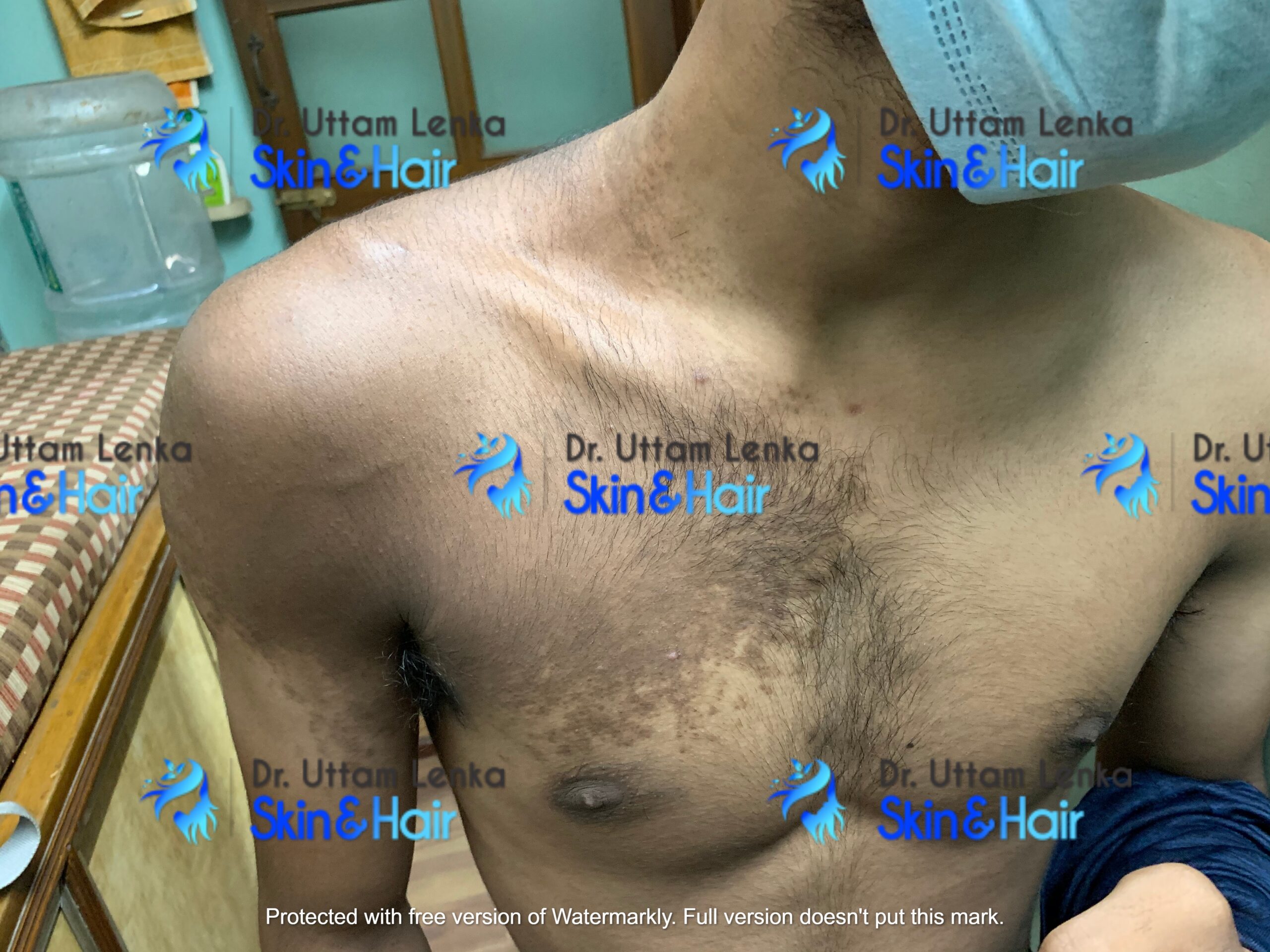 Gallery (Advanced Diagnosis and Treatment) - Dr. Uttam Lenka's Skin ...